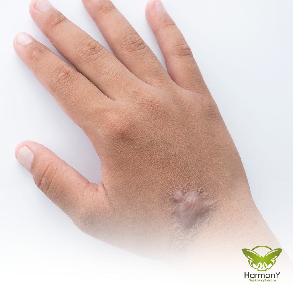 Queloides – Harmony Centro de Nutrición y Estética
